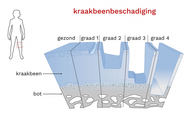 Kraakbeenbeschadiging | Behandelingstraject | Bergman Clinics
